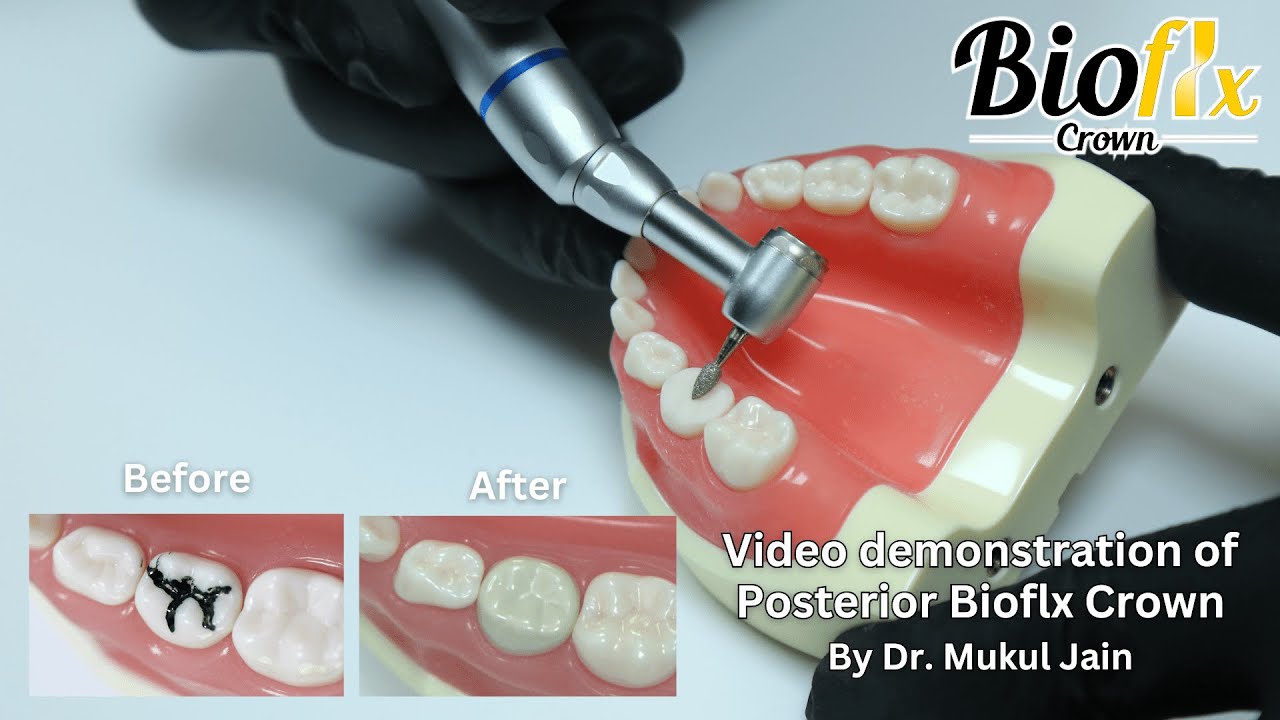 Bioflx Posterior Crown Technique. - YouTube