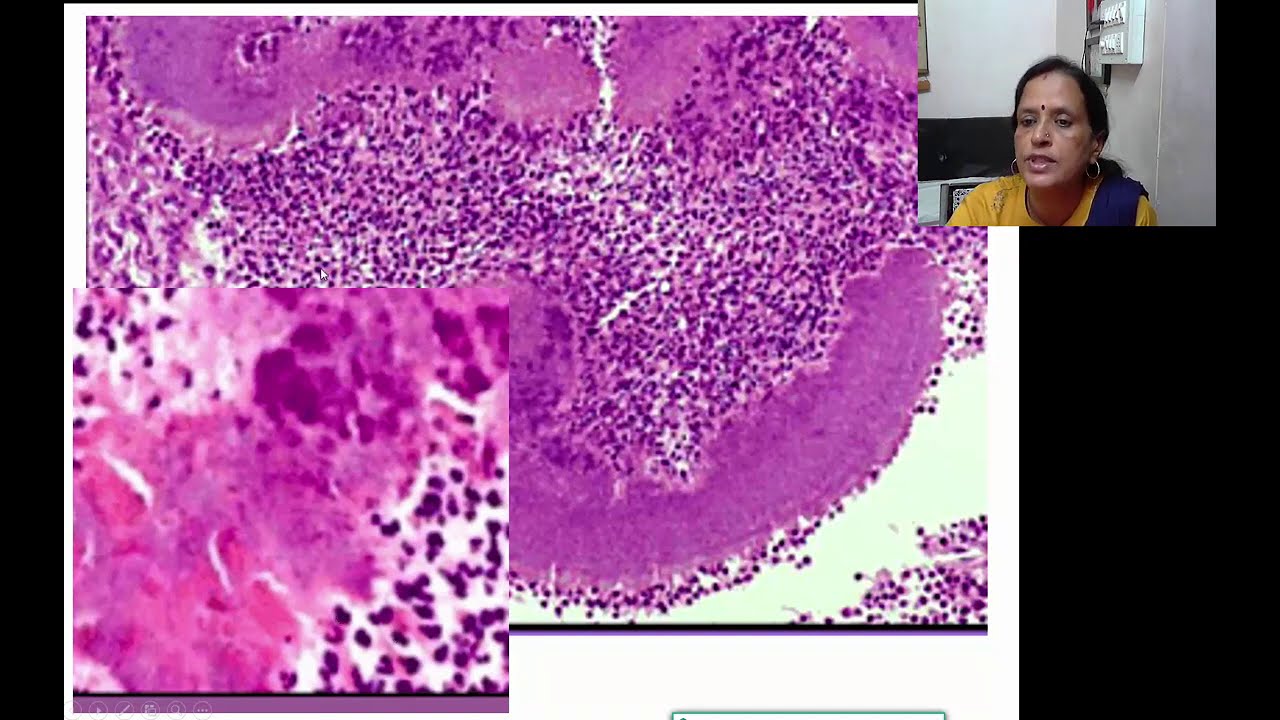 Actinomycosis ,aetiology,clinical manifestations,gross and microscopy ...