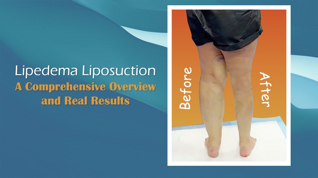 Lipedema Liposuction | Before and After | Expert Dr. Thomas Su - YouTube