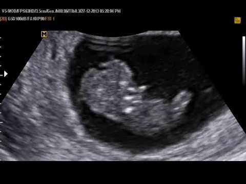 ACRANIA/ Anencephaly sagittal section suspected at 9 WEEKS - YouTube