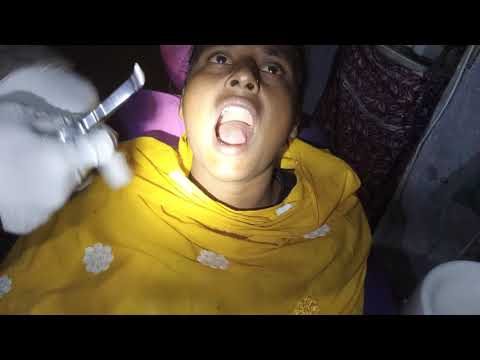 extraction tooth 2nd molars broken and third molars,,,,two easy - YouTube
