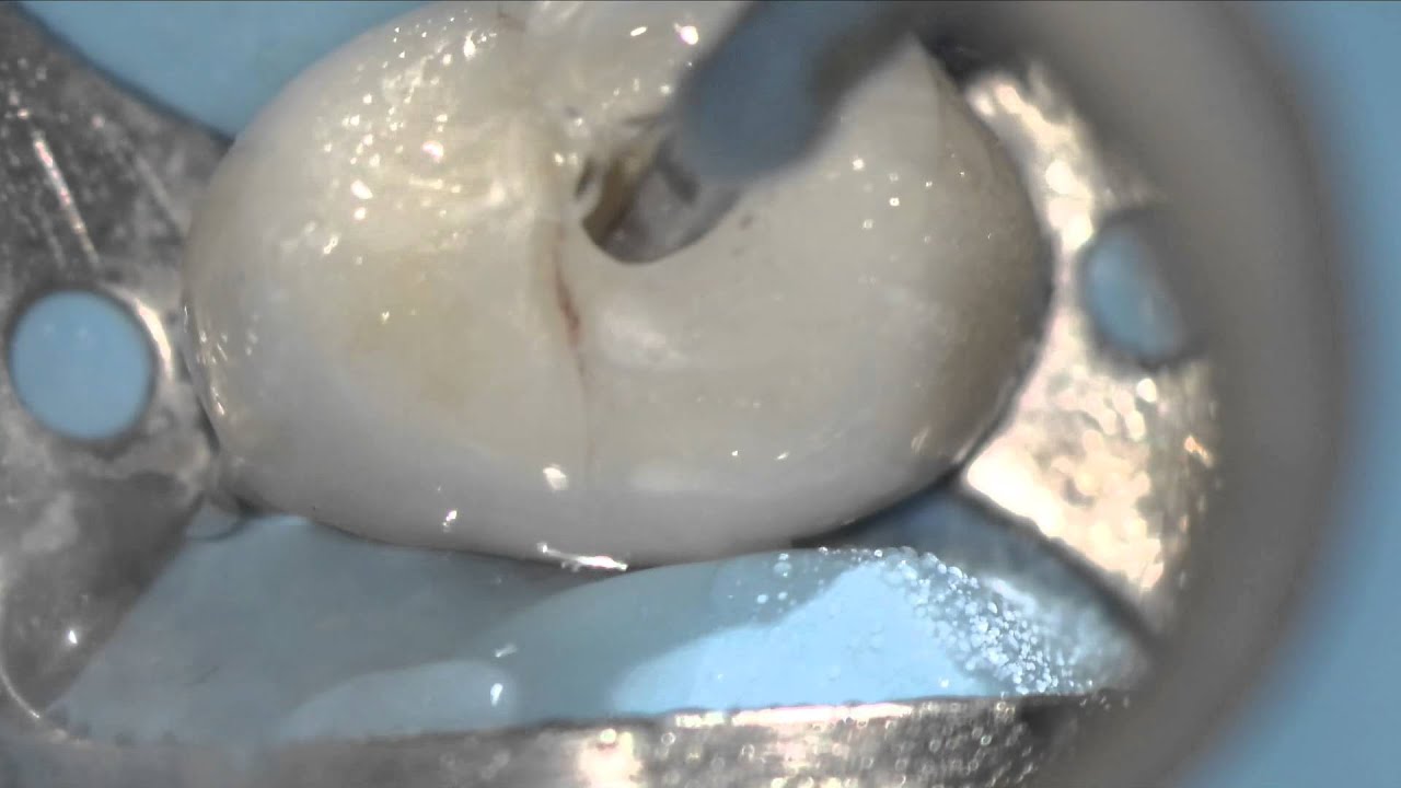 MICRO ACCESS RCT - YouTube