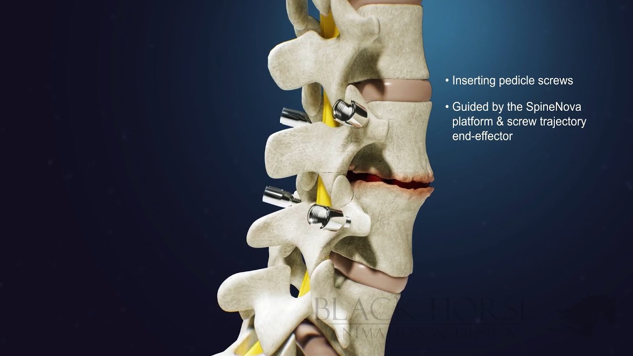 Spine Surgery Animation by Black Horse Animation & Design - YouTube