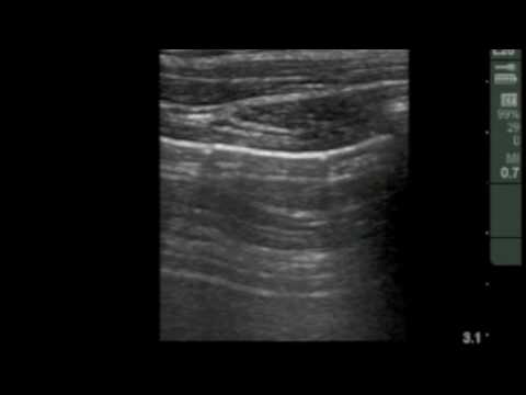 Normal lung sliding - YouTube