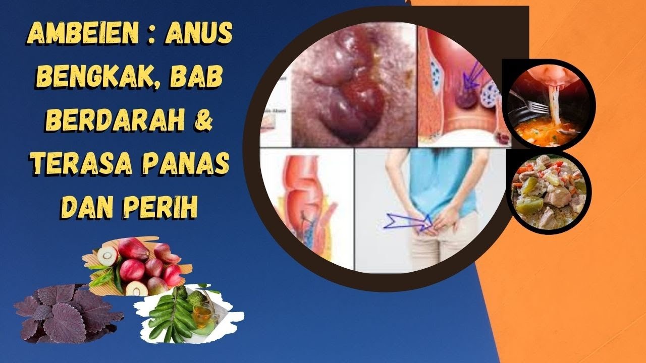 AMBEIEN : ANUS BENGKAK, BAB BERDARAH & TERASA PANAS DAN PERIH - YouTube