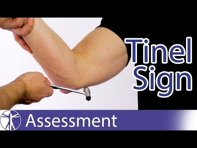 Tinel Sign Elbow Cubital Tunnel Syndrome