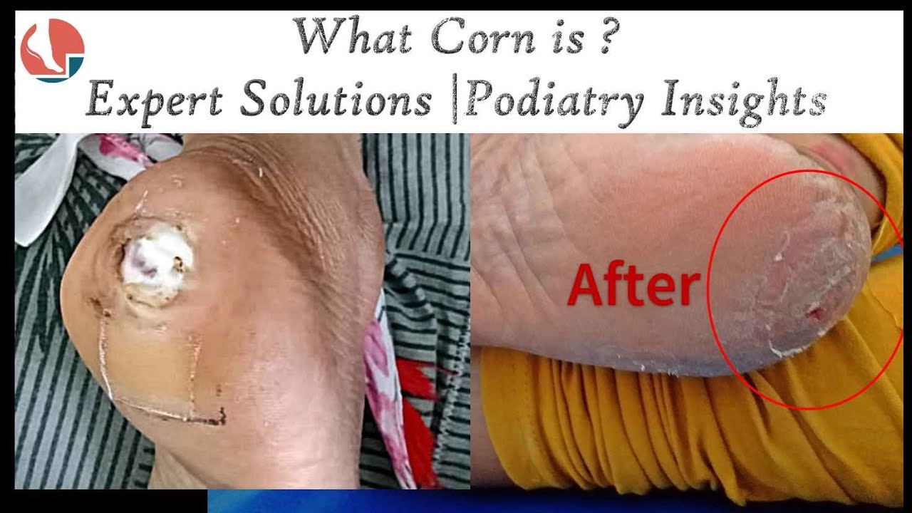 What Corn is: Causes, Myths, and Expert Solutions | Podiatry Insights ...