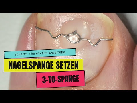 NAGELSPANGE | 3 TO Spange bei EINGEWACHSENEN NÄGELN und ROLLNÄGELN anwenden