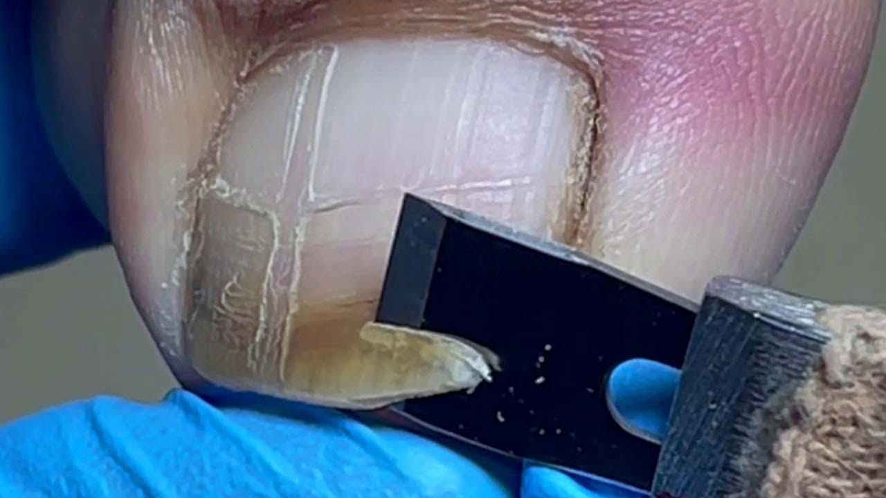 Nail inflammation caused by uncomfortable shoes! - YouTube