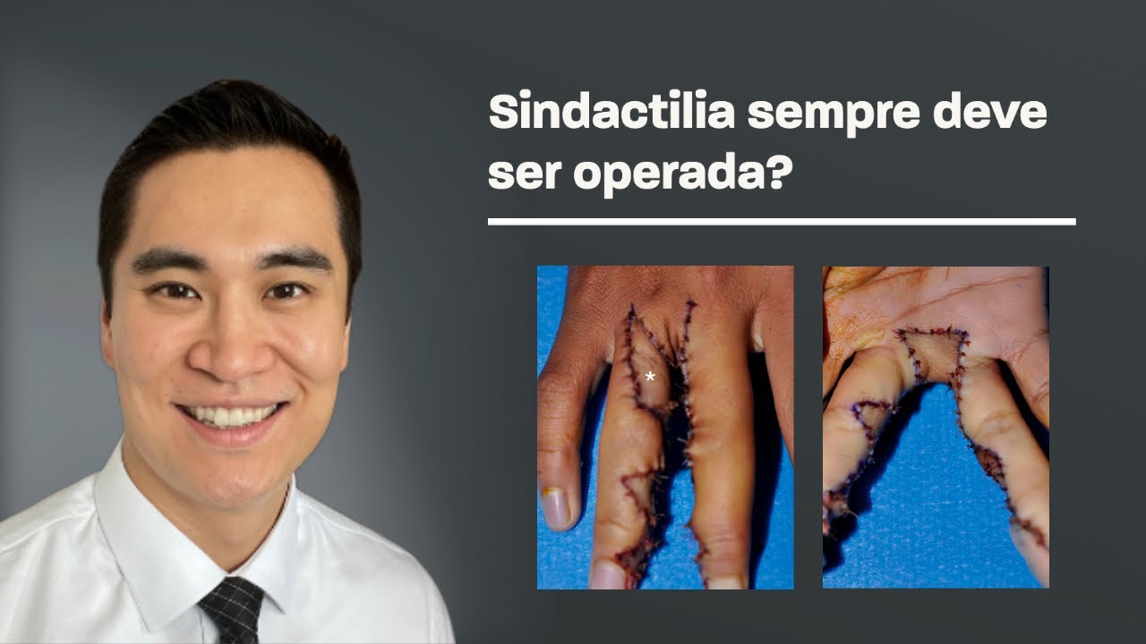Sindactilia na mão, aprenda tudo sobre os tratamentos dessa doença ...