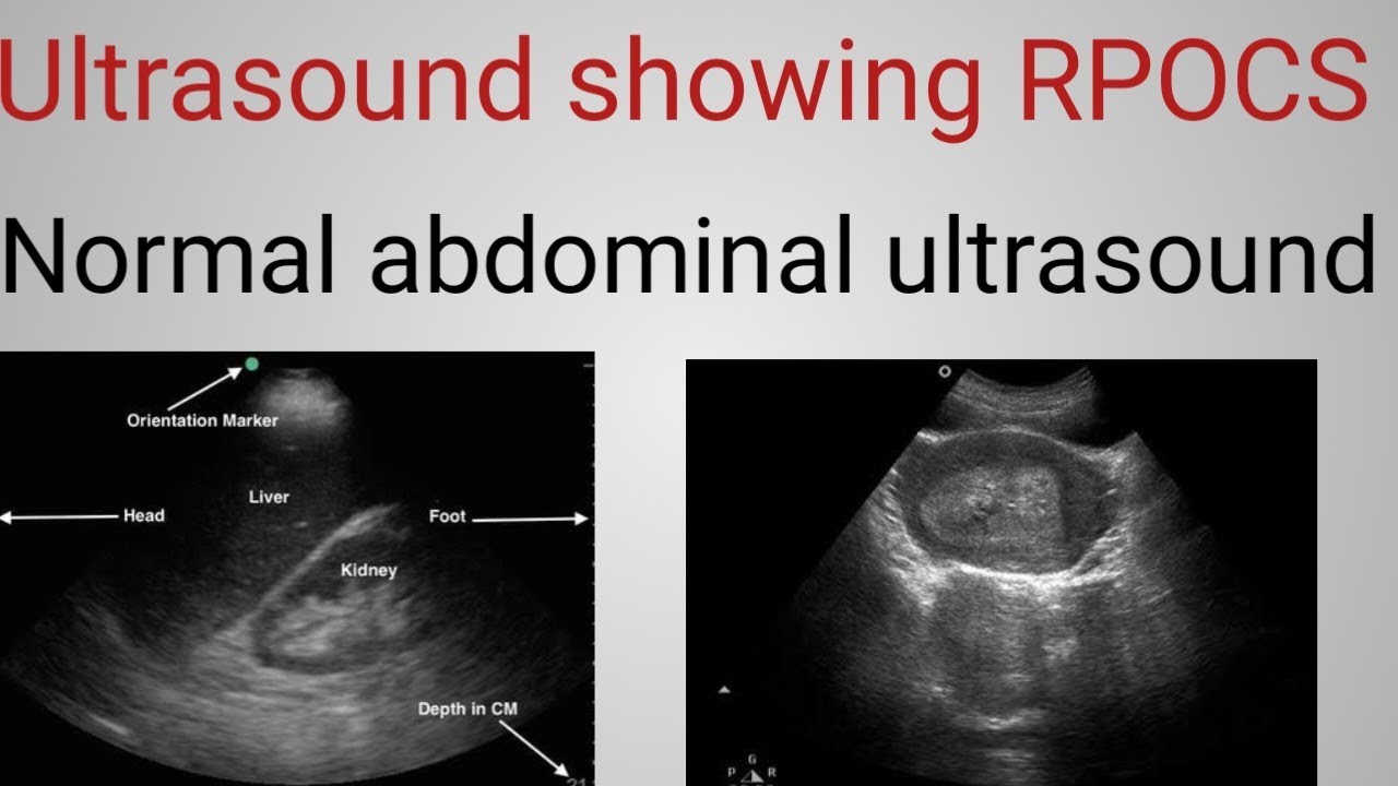 Ultrasound showing RPOCS!Normal abdominal ultrasound!#radiology ...