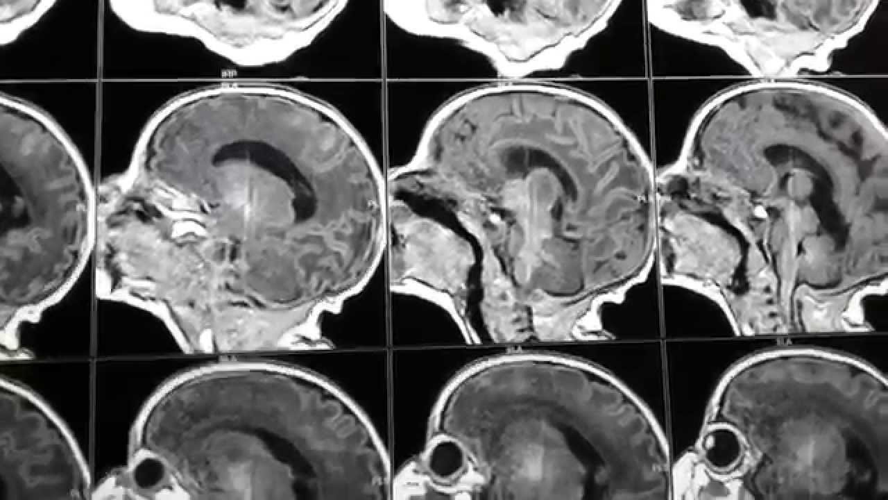 Arnold Chiari syndrome Saggital MRI - YouTube