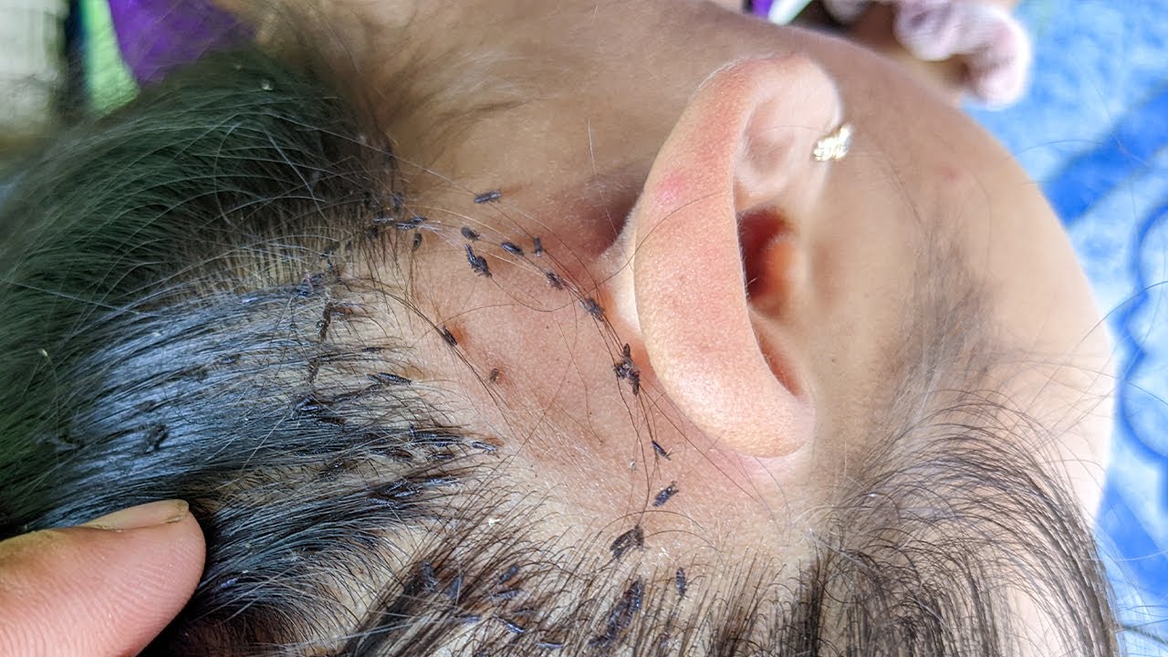Get well remove those head lice - How to getting out a lot of big head ...