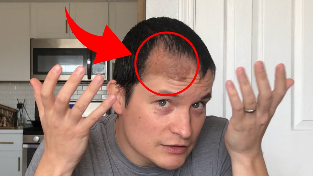What it’s like having a BIRTHMARK on your head - YouTube