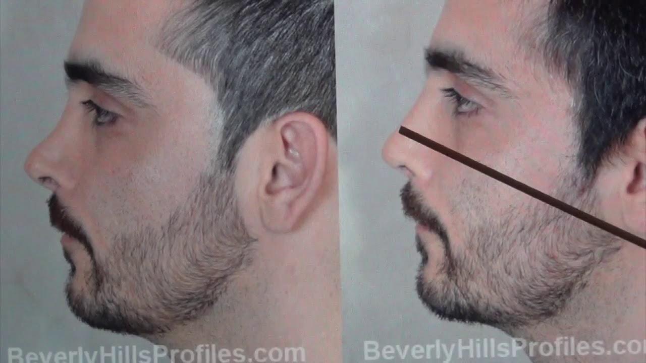 Over Resection in Rhinoplasty | Beverly Hills Profiles - YouTube
