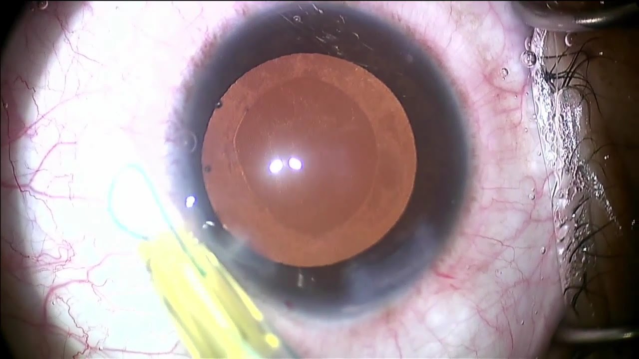 3 Piece Intraocular Lens Insertion - YouTube