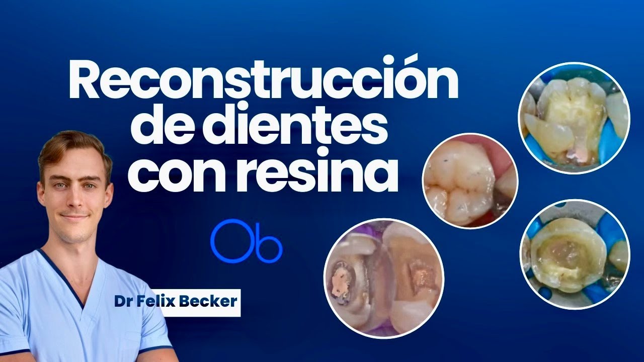 Reconstrucción de dientes con resina a mano alzada y elevación de ...
