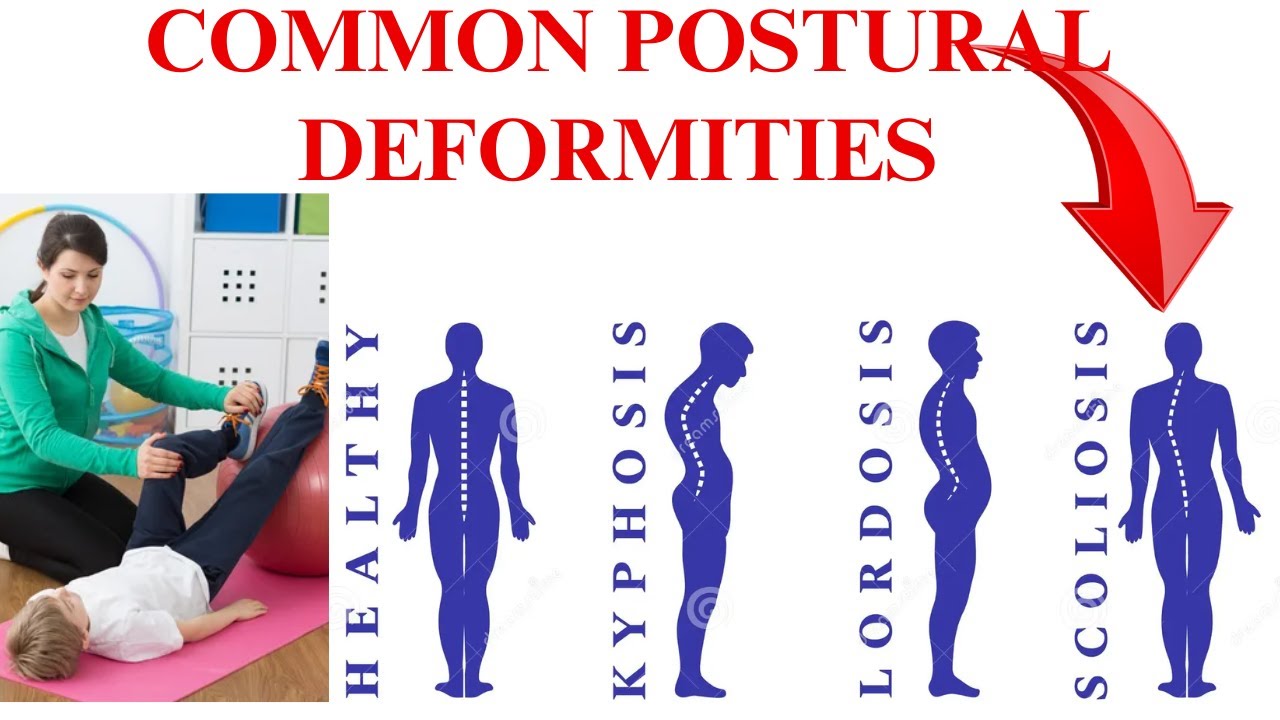 POSTURAL DEFORMITIES POSTURAL DEVIATION CLASS 12 B P ED M P ED - YouTube