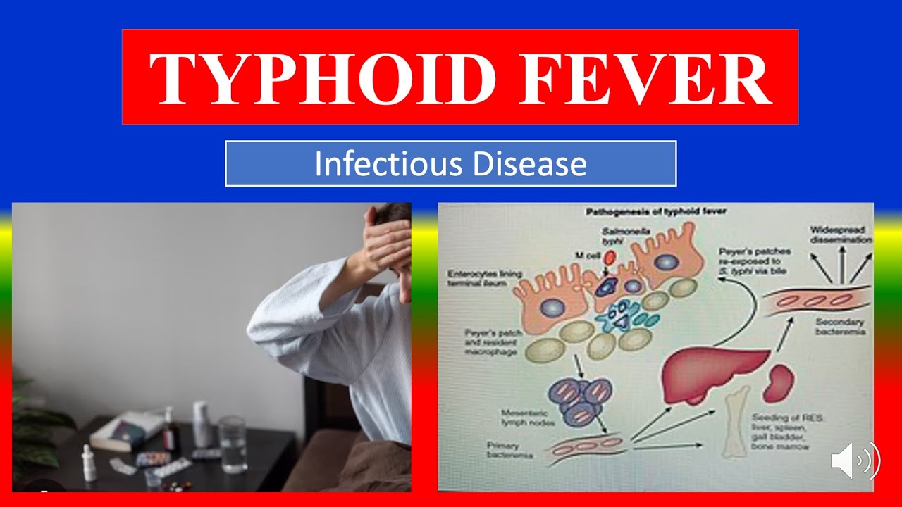TYPHOID FEVER - Definition, types, causes, pathophysiology, signs ...