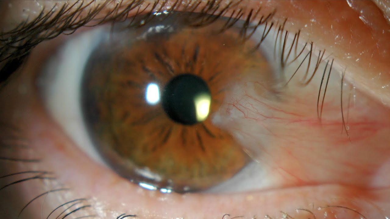 Pterigion (carnosidad, palmera, uña) - YouTube