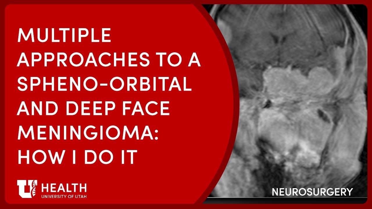 Multiple Approaches to a Spheno-Orbital and Deep Face Meningioma: How I ...