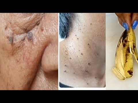 Remove skin tag in 1 day strong skin tag treatment - YouTube