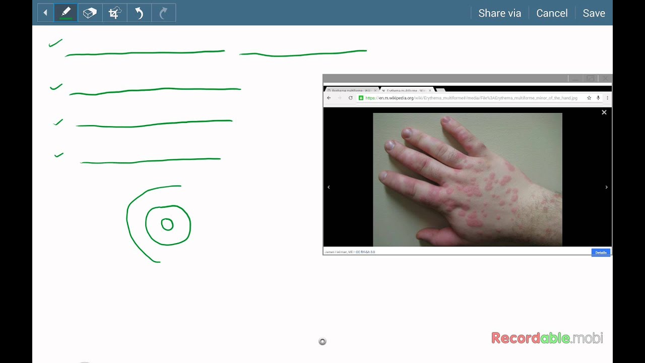 Dermatological drug reactions: erythema multiforme - YouTube