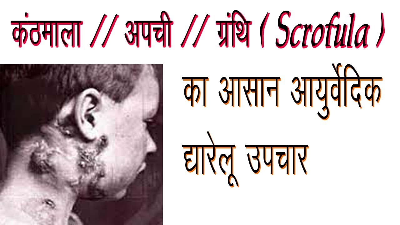 कंठमाला // अपची // ग्रंथि ( Scrofula ) के लक्षण और आयुर्वेदिक उपचार ...