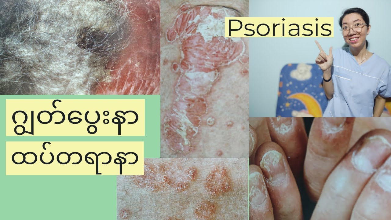 Psoriasis သိသင့်သောအရေပြားဂျွတ်ပွေးနာခေါ်ထပ်တရာနာ - YouTube