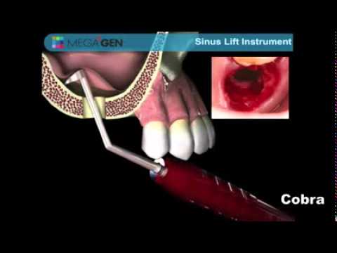 Sinus Lift : Crestal Protocol With Implant Placement - YouTube