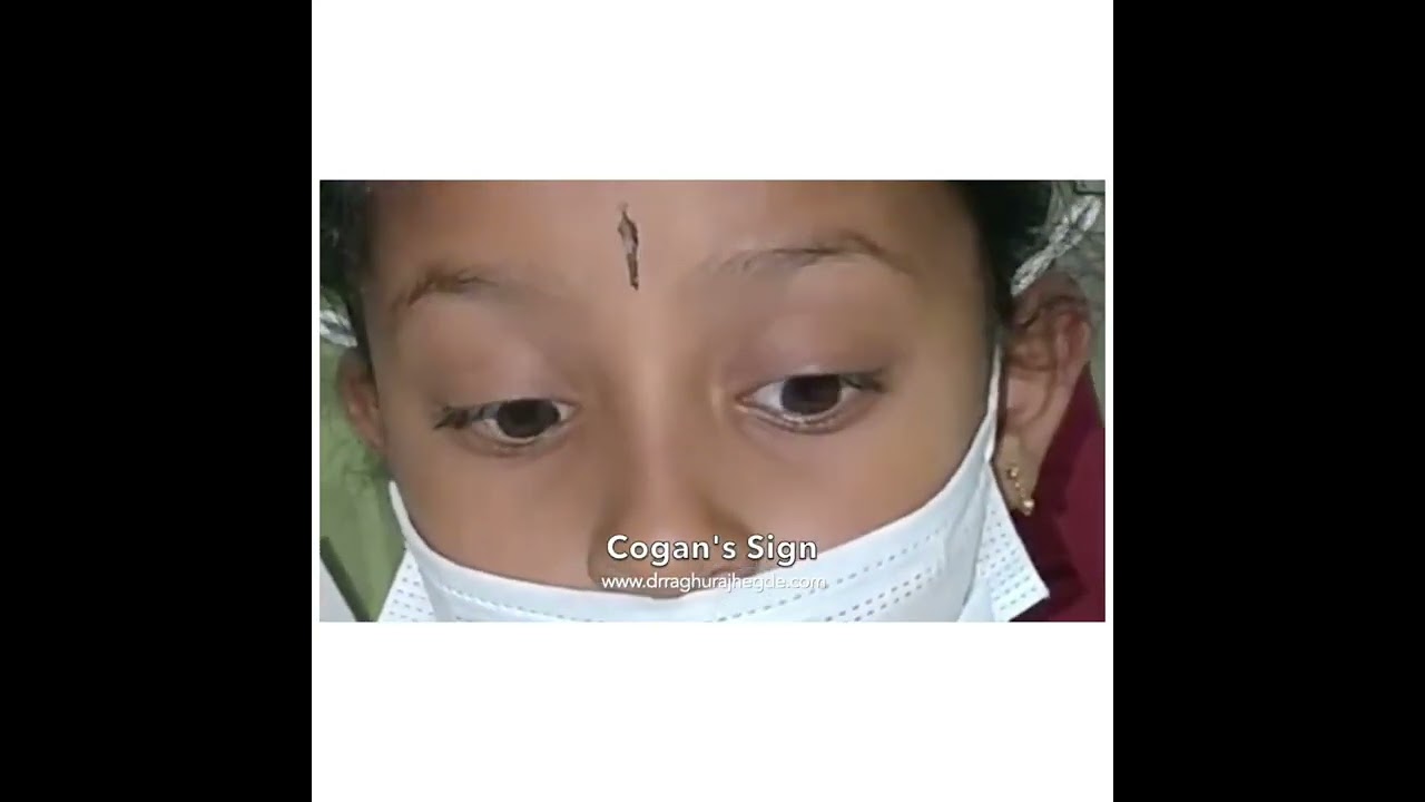 Cogan’s Lid Twitch Sign - YouTube