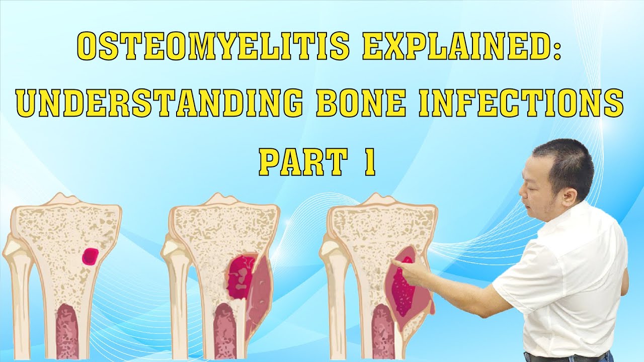 Osteomyelitis Explained: Understanding Bone Infections - Part 1 # ...