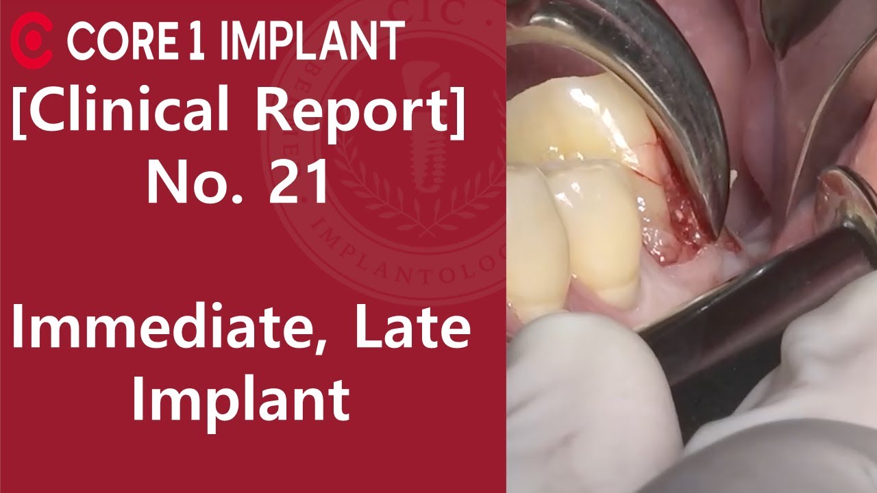 36b Implants