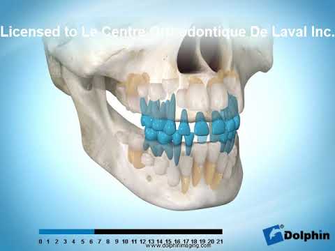Eruption normale dents permanentes-Normal eruption of permanent teeth ...