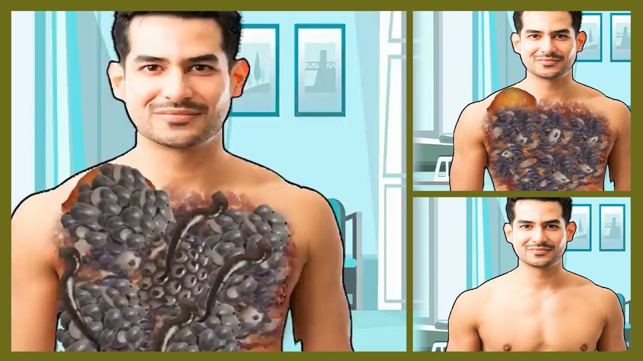 ASMR chest treatment | 2D worms removal animation | ASMR huge infected ...