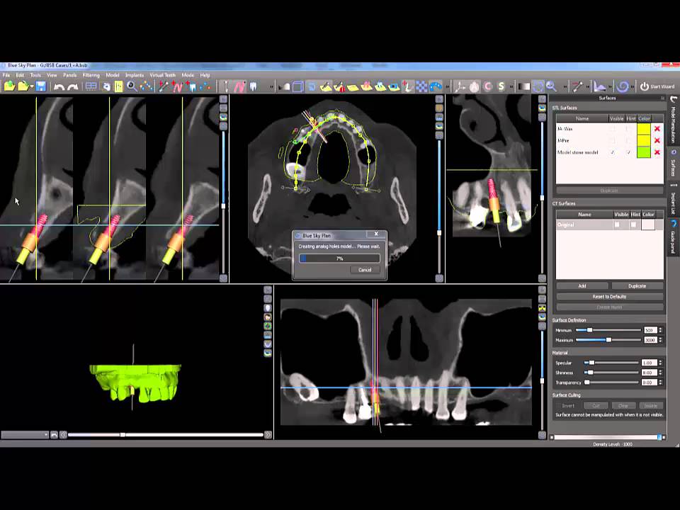 BSP Training Tutorial: Creating Holes for Implant Analogs in STL Model - YouTube