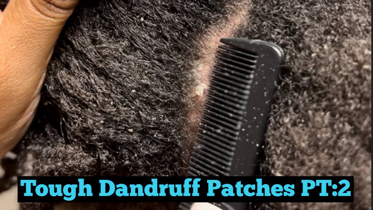 Dandruff Patches | Flakes | Itchy Flakes #flakes #dandruff #itchyscalp ...