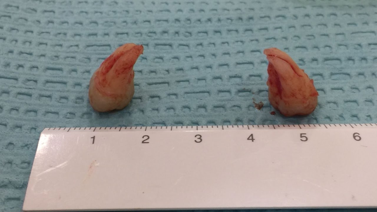 Extraction of upper left and right wisdom teeth in 76 seconds! - YouTube