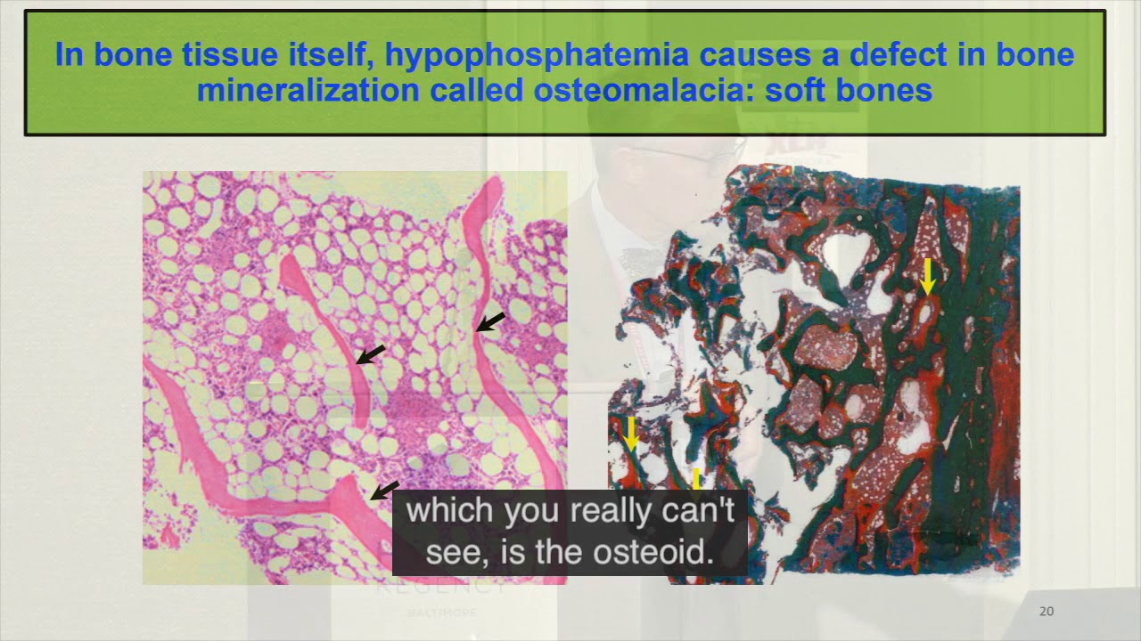 The Symposium on Hypophosphatemia: Clinical Overview - YouTube