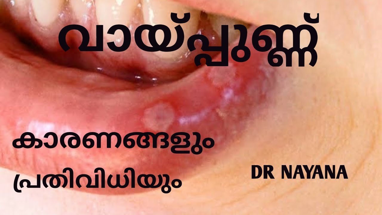 Mouth Ulcer Causes And Prevention Aphthous Ulcer Dr Nayana Youtube