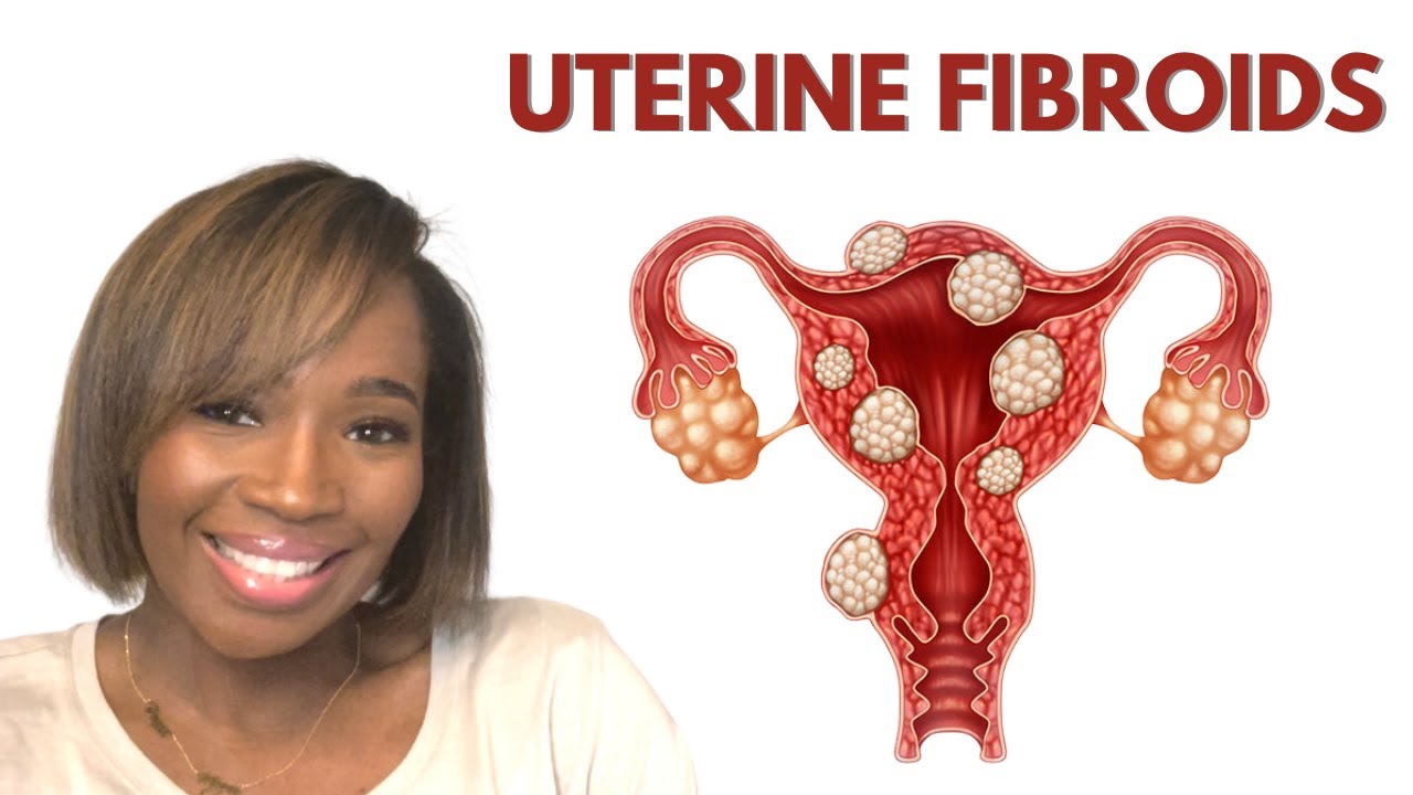 What Are Fibroids Youtube