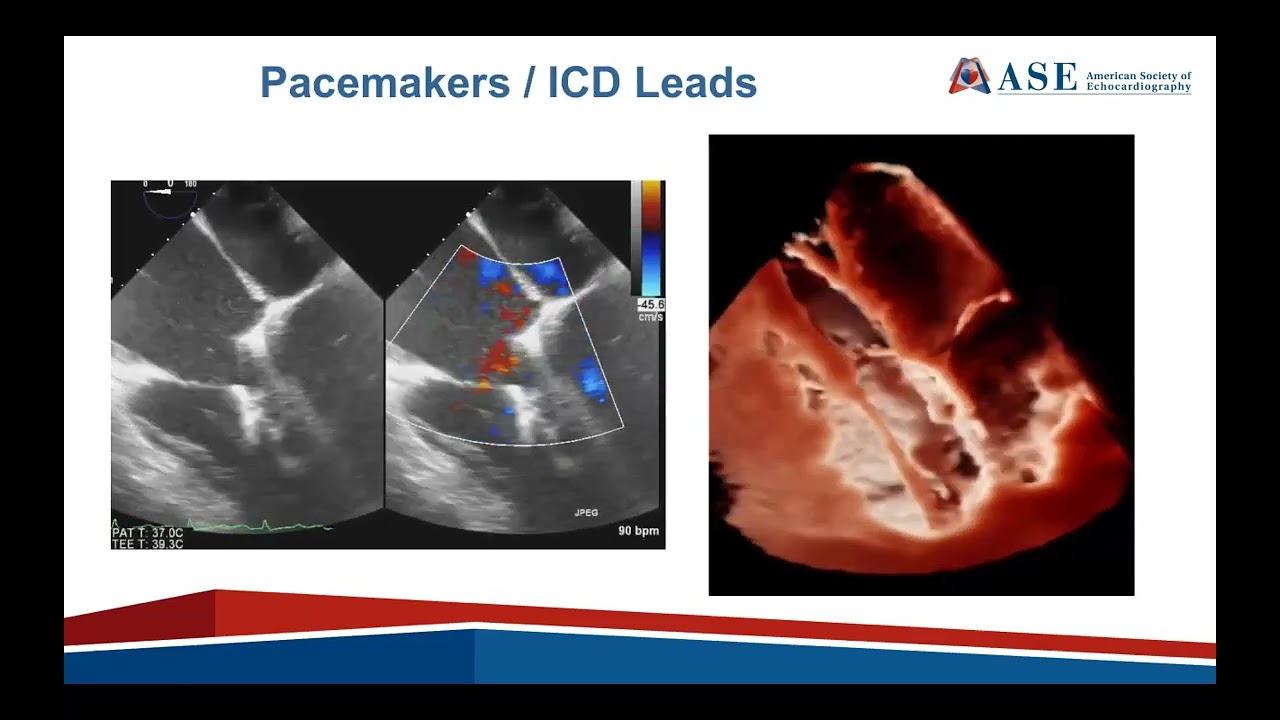 ASE 2021 Cardiac Masses Cardiac Sources of Embolism - YouTube