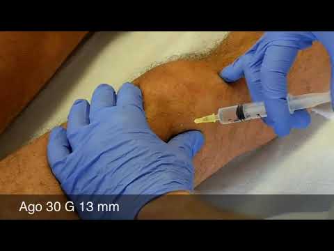 Collagen injection around the knee - YouTube