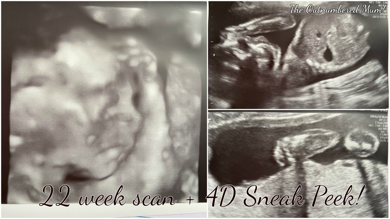 Gender Ultrasound 22 Weeks + 4D Sneak Peek! Baby Number 3! 2020 UK ...