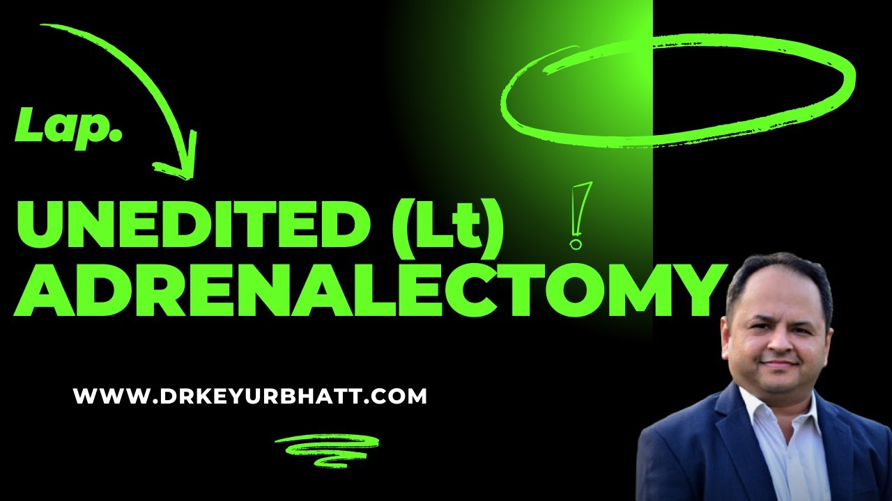Live Left adrenalectomy Unedited | Left adrenal surgery | How to do lap ...