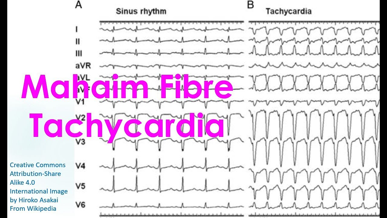 Mahaim Fibre Tachycardia - YouTube