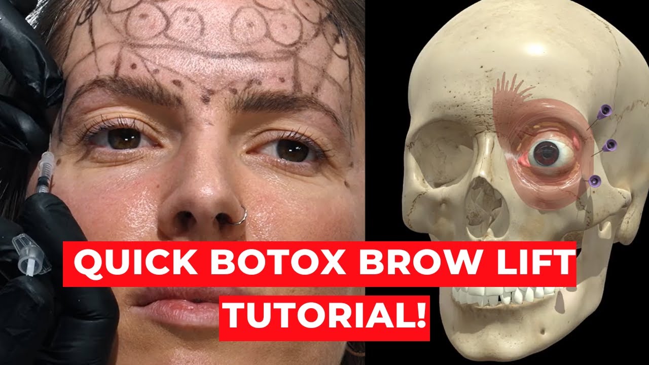 3D Botox BROW LIFT INJECTION TUTORIAL - YouTube