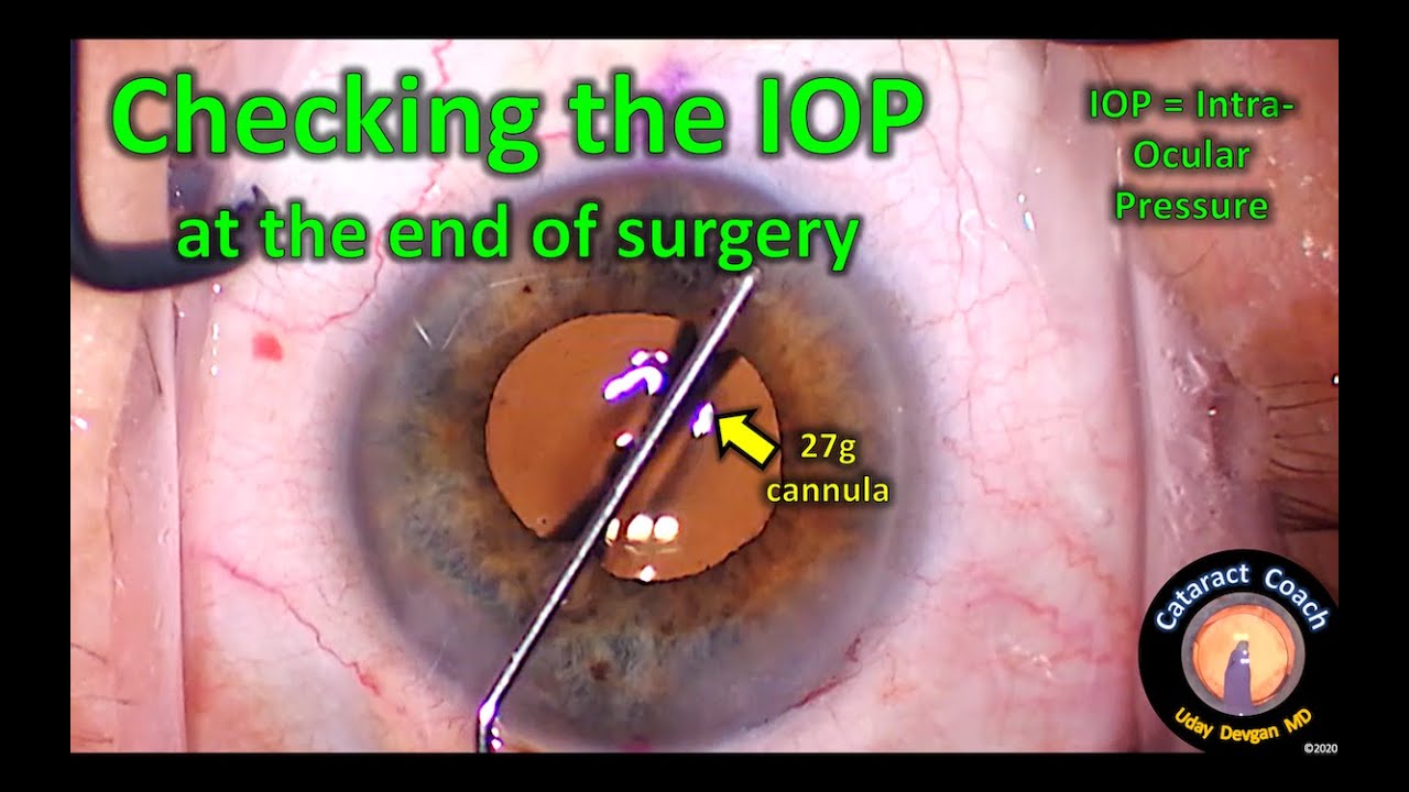 Checking the IOP at the end of cataract surgery (intra-ocular pressure ...