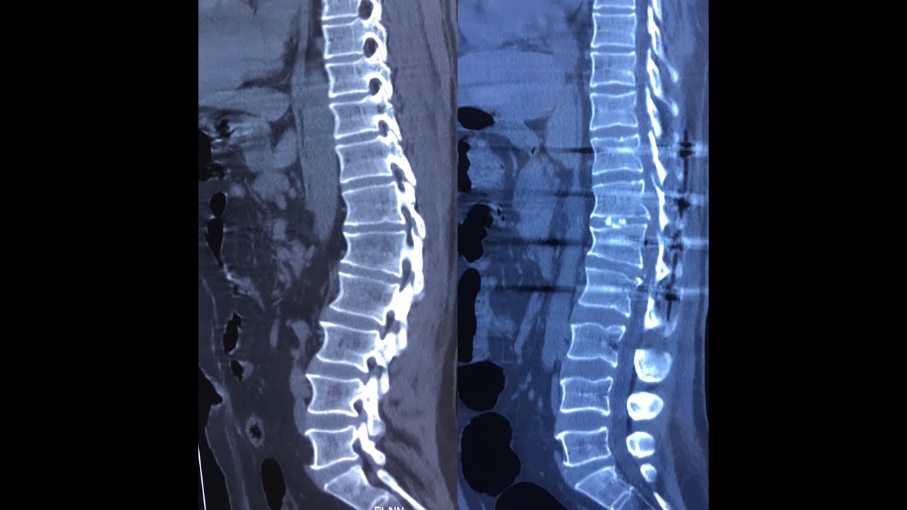 Minimally Invasive TLIF at D12-L1 - YouTube