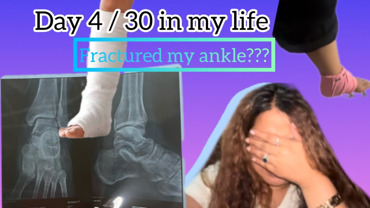 Day 4/30 in my Life || Fractured my leg? || Xray and Hospital visit ...
